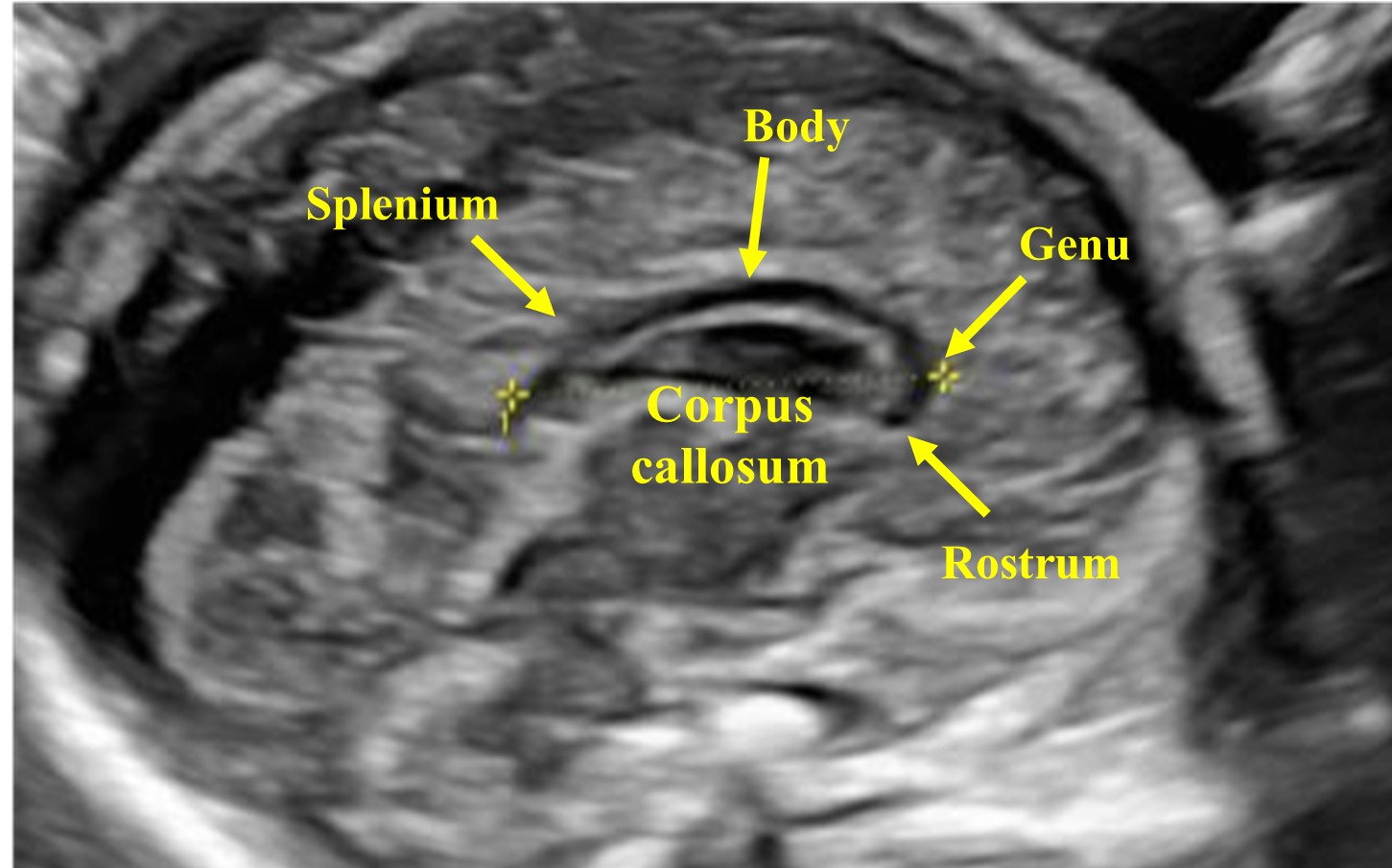 Ultrasound Images Of Fetal Brain Ultrasound Images of Fetal Brain